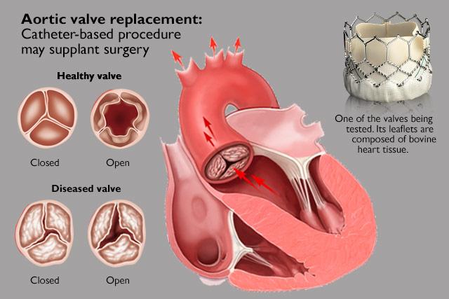Aortic Valve Disease